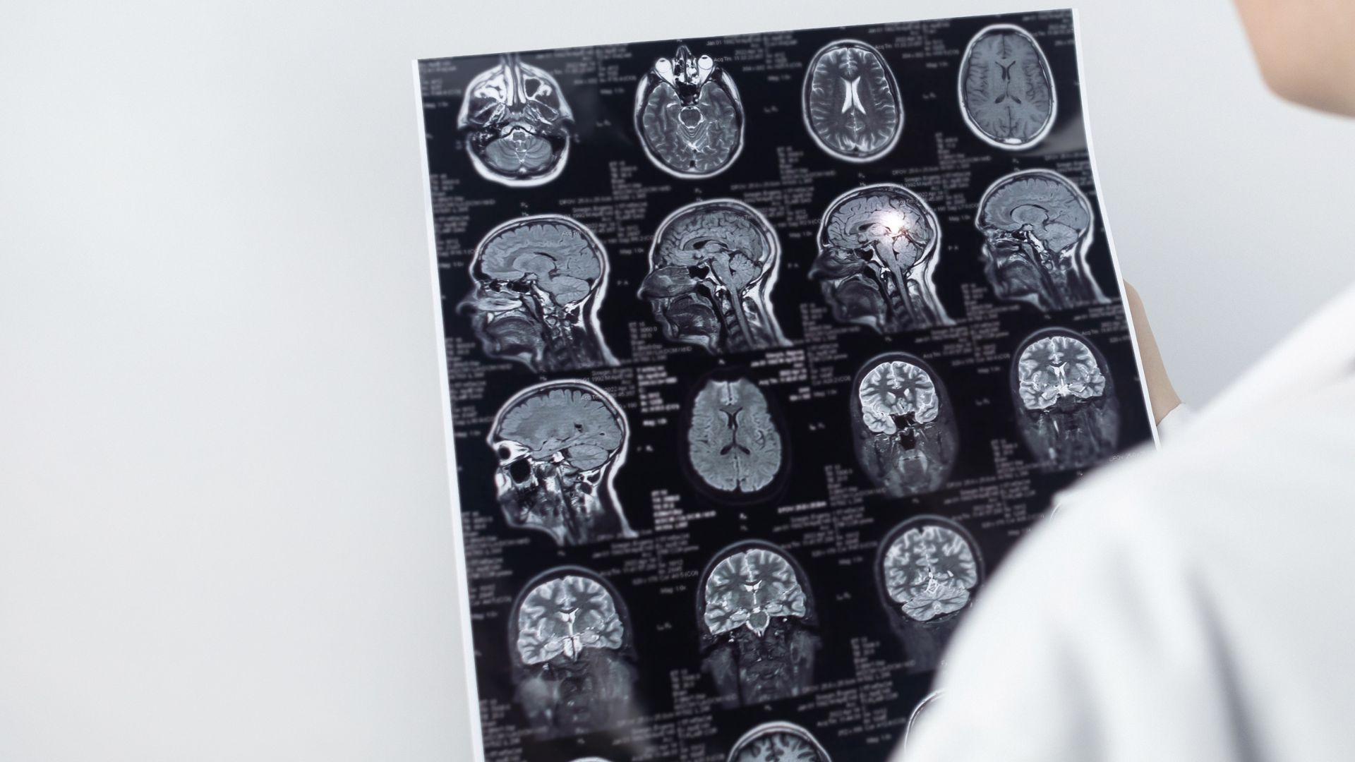 Brain Injuries Resulting from Slip & Falls in Florida: Who is Liable?